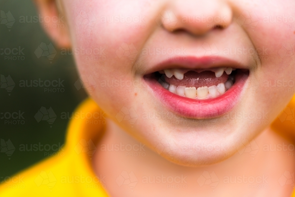 Image of Young school girl showing her missing front teeth - Austockphoto